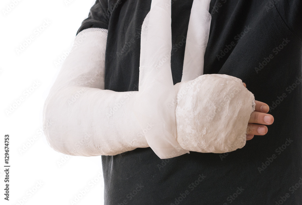 Broken arm in white plaster cast and sling Stock Photo | Adobe Stock