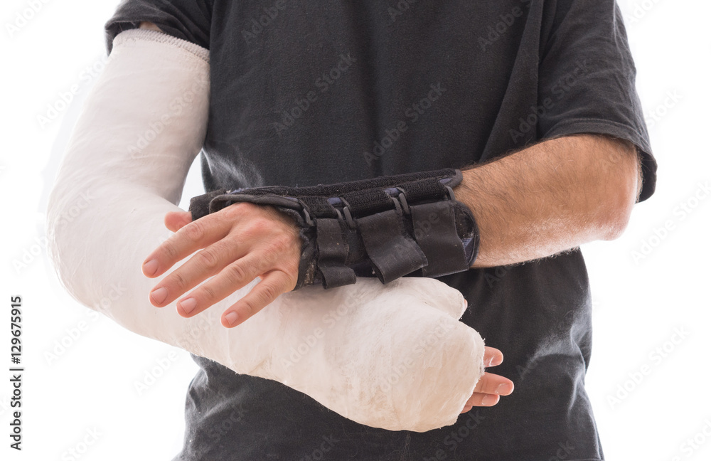 Young man wearing a long arm cast and a splint foto de Stock | Adobe Stock