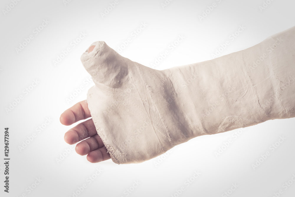 Arm plaster / fiberglass cast with the thumb extended Stock Photo ...