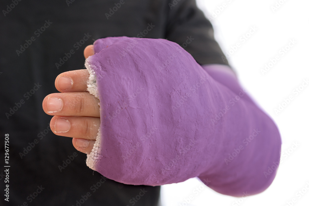 Close up of a long arm cast Stock-Foto | Adobe Stock