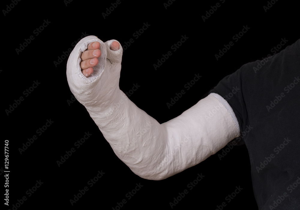 Young man wearing a long arm plaster / fiberglass cast Stock Photo ...