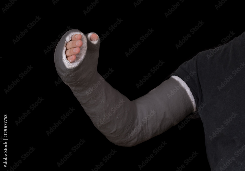 Long Arm Cast
