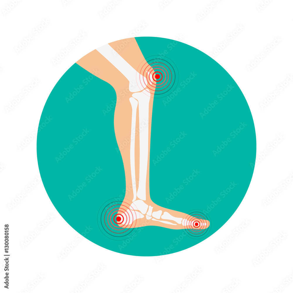 Human leg pain zones. Design elements for infographic. Vector ...