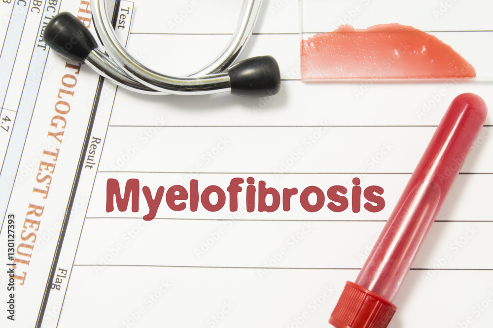 Diagnosis of Myelofibrosis. Laboratory blood bottle (tube), glass slide ...