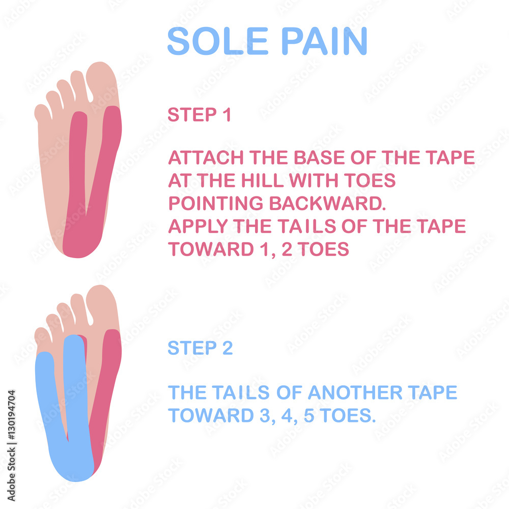 Sole pain. Correct kinesiology taping. Vector illustration. Stock ...