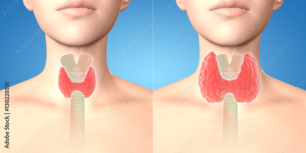 Struma - Schilddrüsenvergrößerung Stock-Illustration | Adobe Stock
