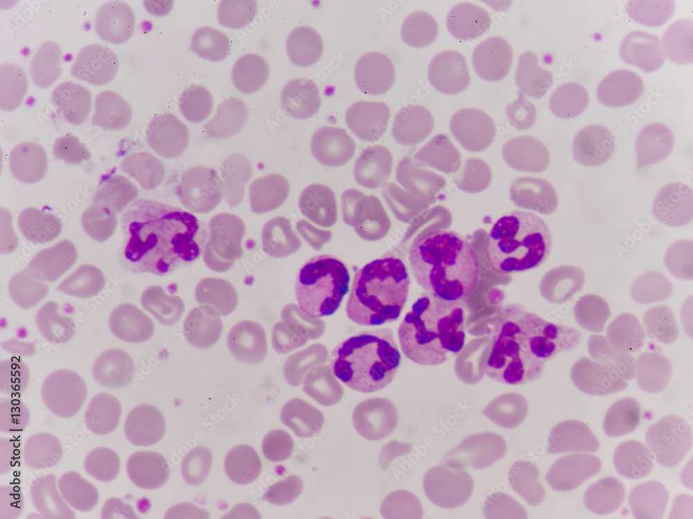 Cancer Cell in human showing abnormal cells. Stock Photo | Adobe Stock