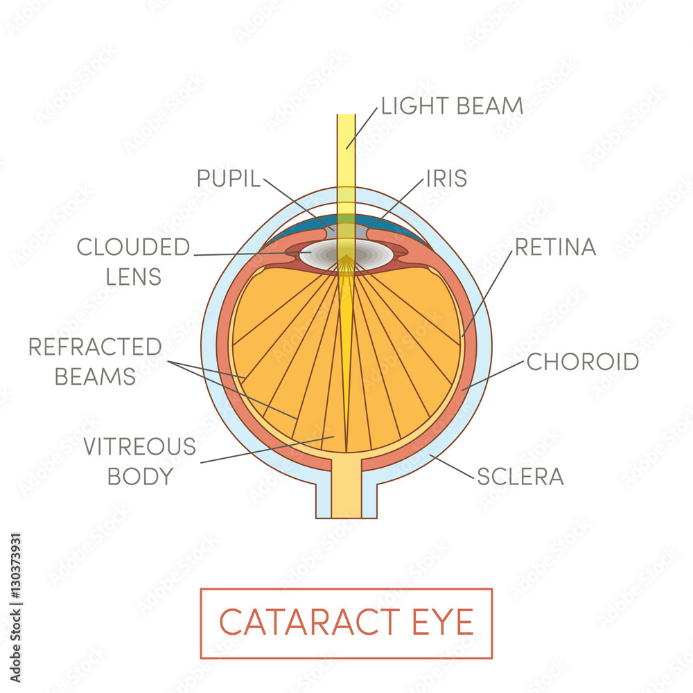 Cataract eye, vector Stock Illustration | Adobe Stock