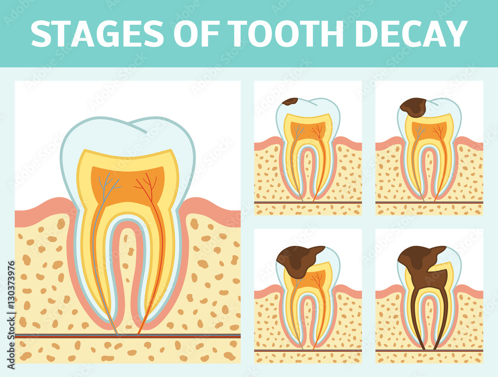 Tooth decay stages Stock Illustration | Adobe Stock