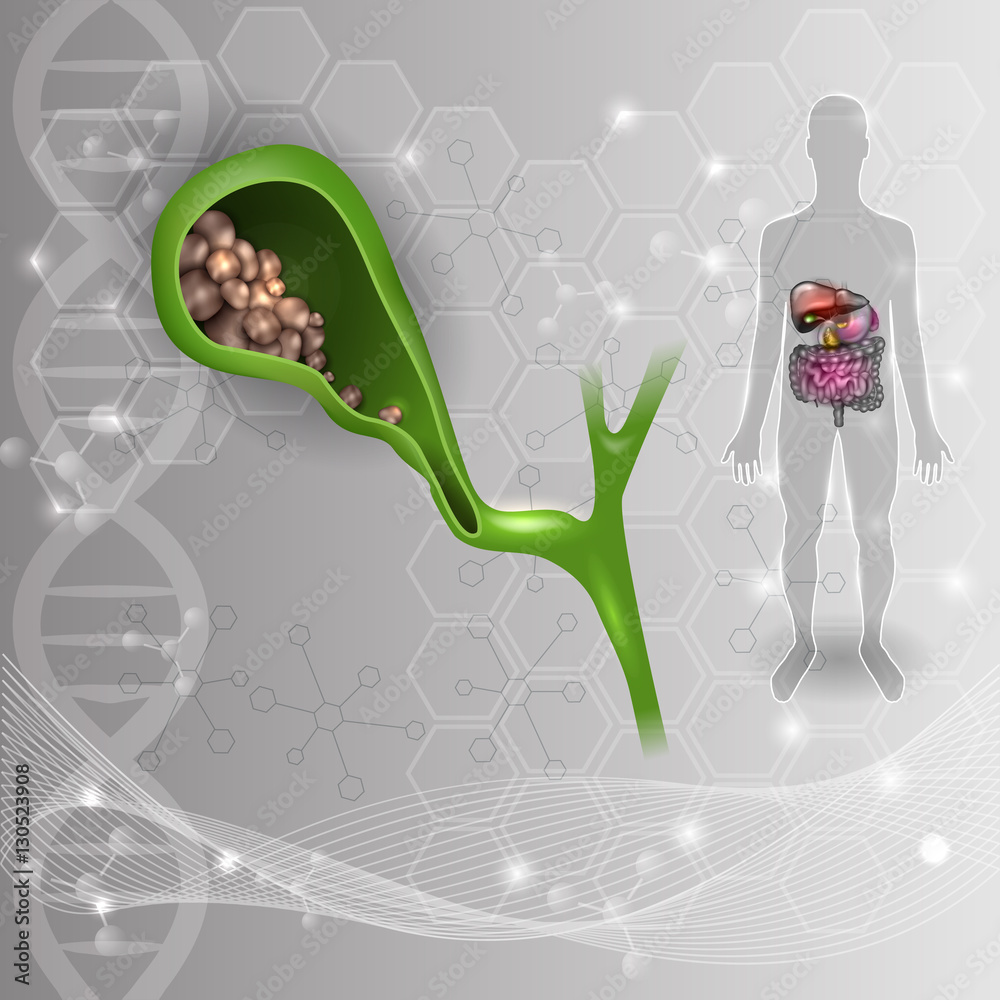 Gallstones in the Gallbladder, anatomy bright detailed illustration on ...