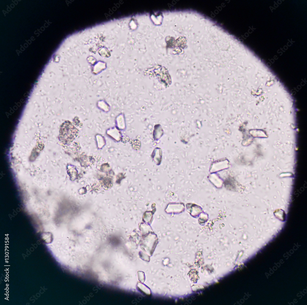 Moderate triple phosphate with bacteria in urine analysis medica Photos ...