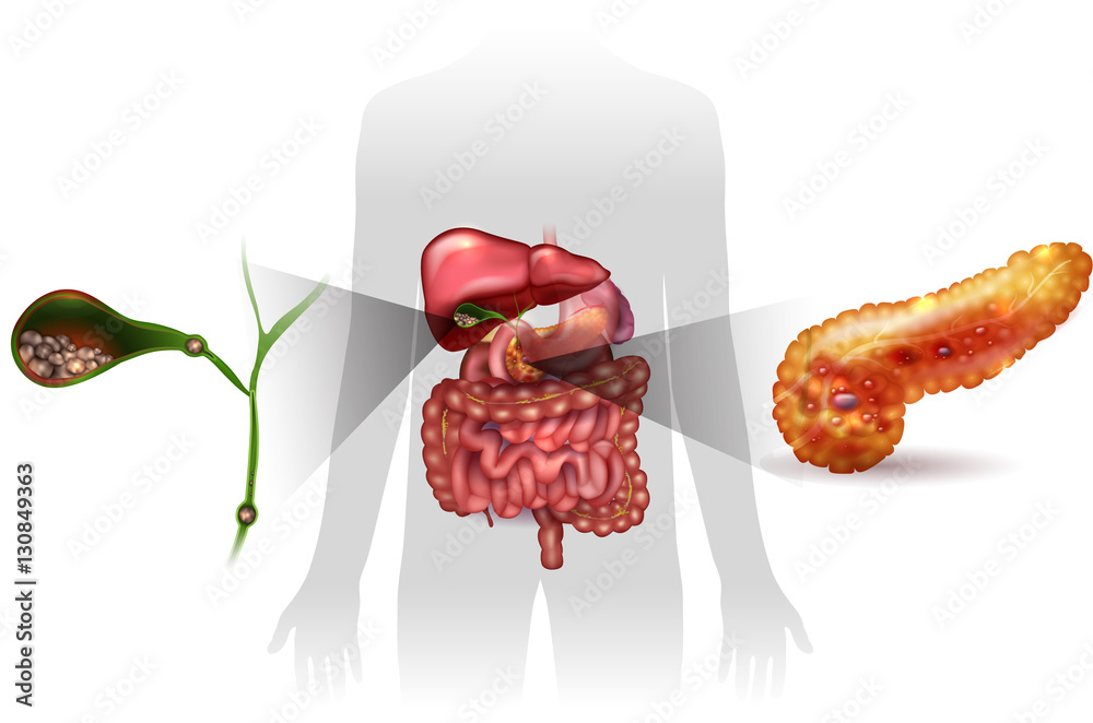 Gallstones in the Gallbladder and acute pancreatitis, anatomy bright ...