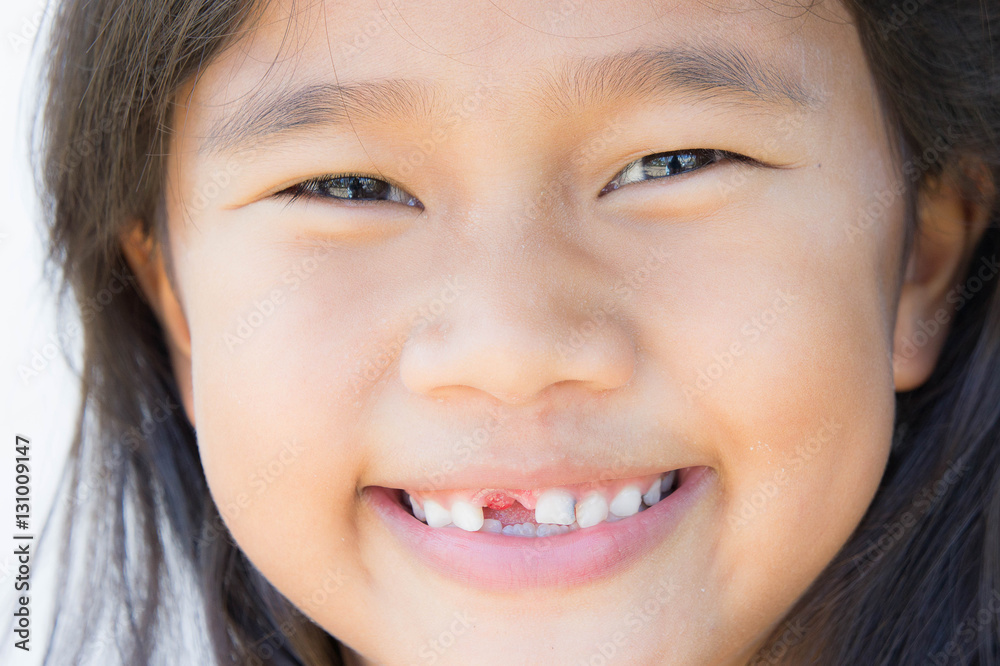 Asian girl smiling broken tooth Stock Photo | Adobe Stock