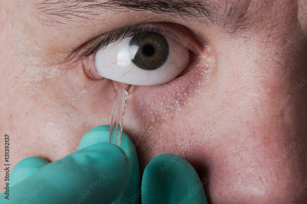 Glass eye prosthetic extraction of Ocular prosthesis Stock Photo ...
