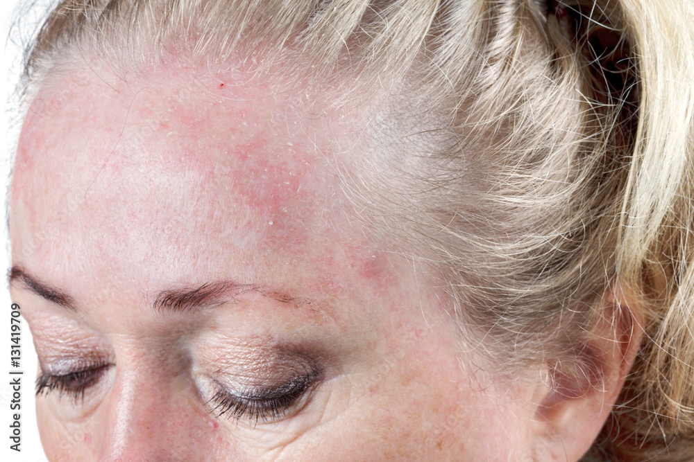 Mature woman's very dry skin from seborrheic dermatitis Stock Photo ...