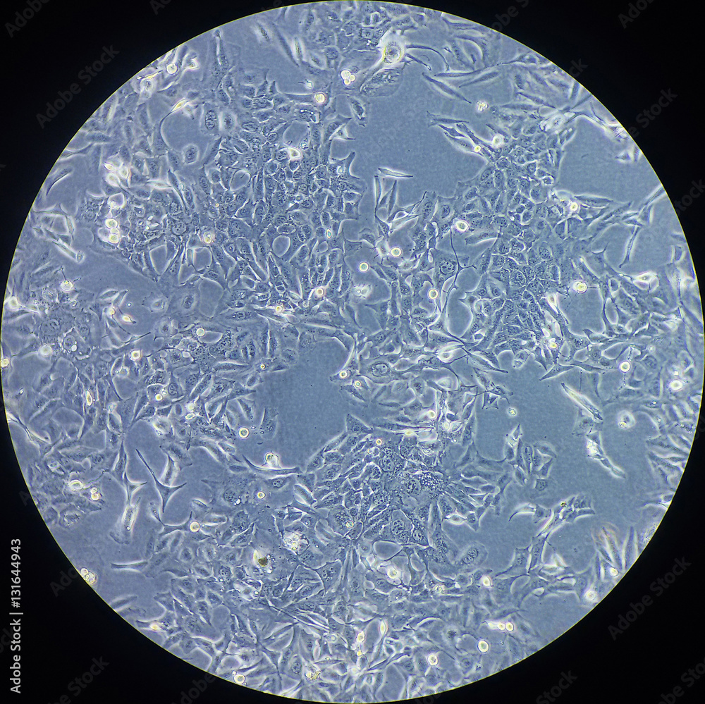 Cancer cells under microscope Stock Photo | Adobe Stock