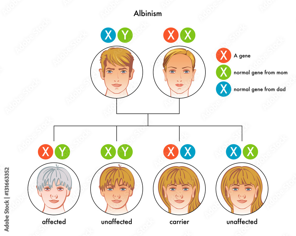albinism Stock Vector | Adobe Stock