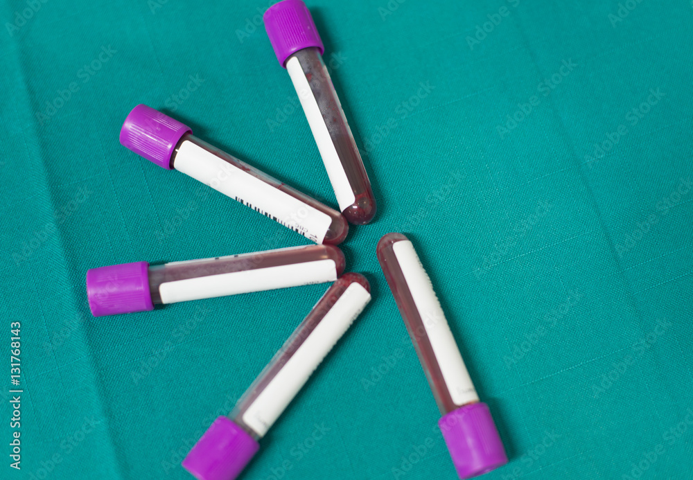 CBC Blood test tube in laboratory. Stock Photo | Adobe Stock