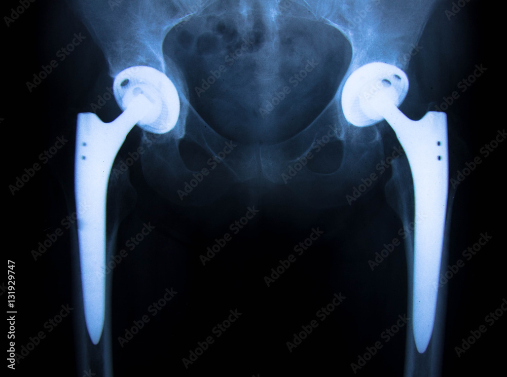 Hüft-TEP - künstliches Hüftgelenk Stock-Foto | Adobe Stock