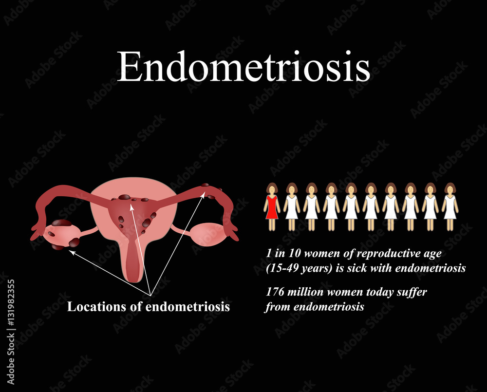 Endometriosis. Endometrial cysts. The endometrium. Statistics . The ...
