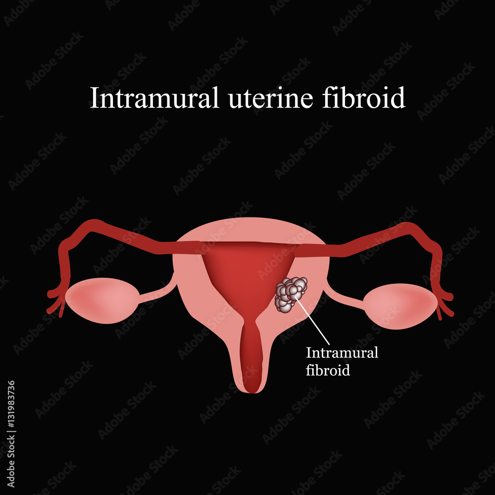 Intramural fibroids. Endometriosis. Infographics. Vector illustration ...