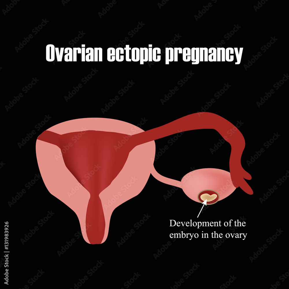 Development of the embryo in the ovary. Ectopic pregnancy. Infographics ...