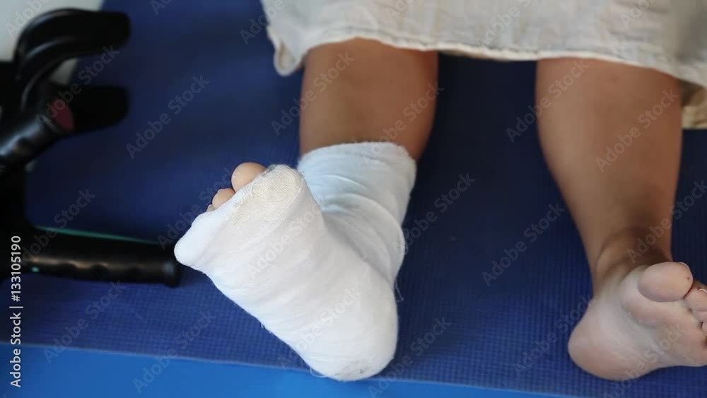 Vidéo Stock Woman with plaster on the right foot. Fracture of the right ...