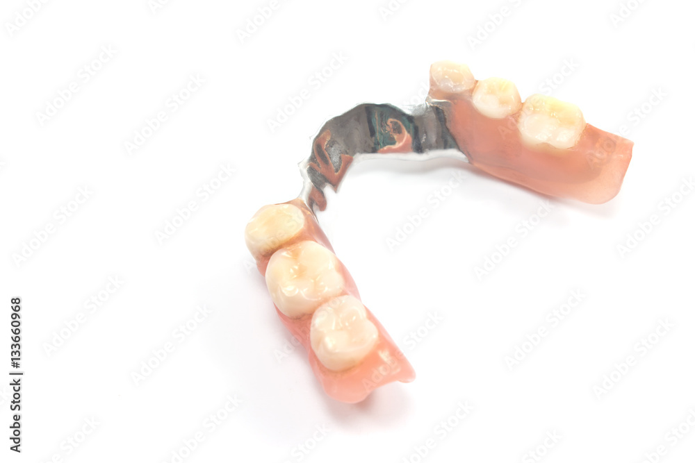 Partial denture upper side - dental prosthetics isolated on whit Stock ...