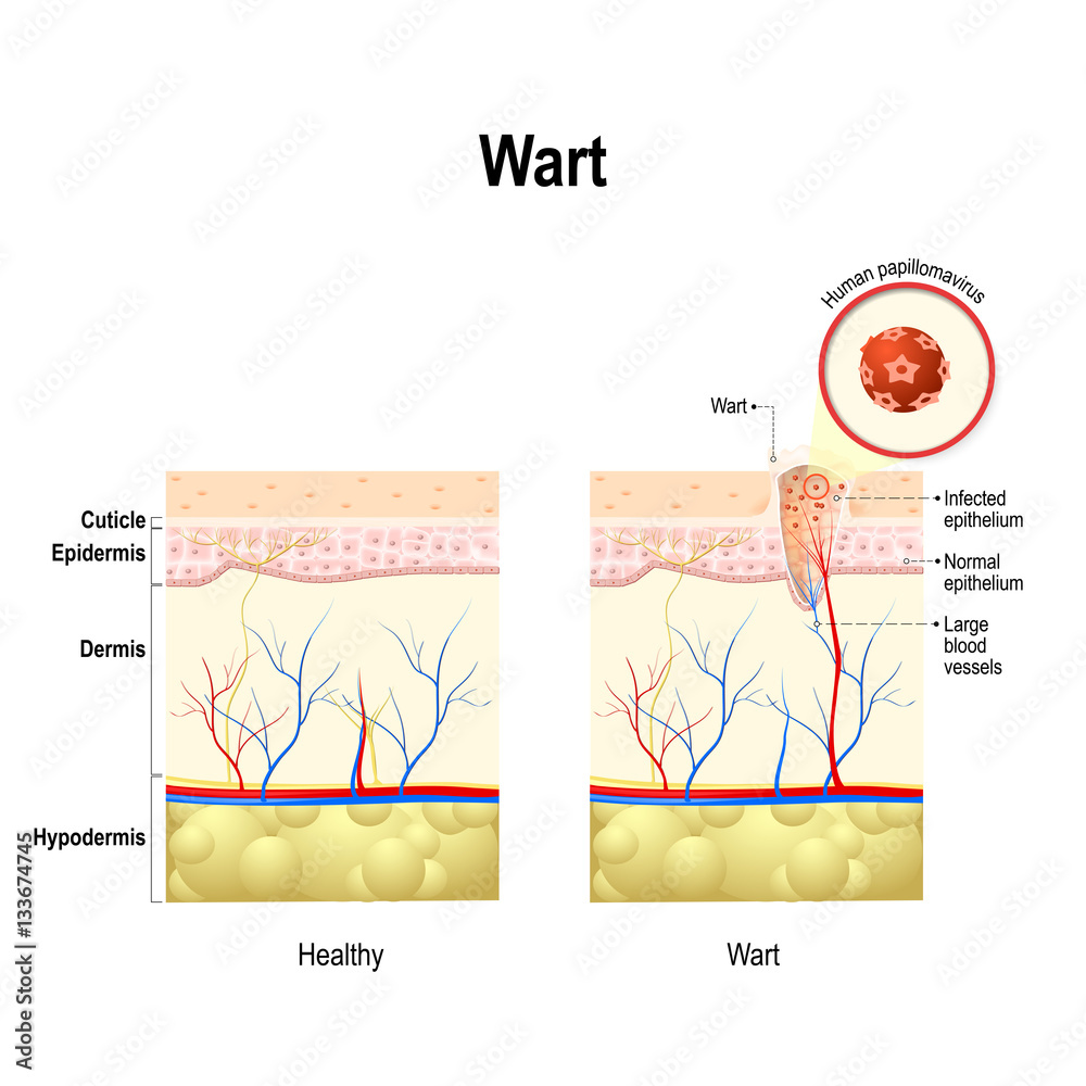 Wart. Human papillomavirus infection vector de Stock | Adobe Stock