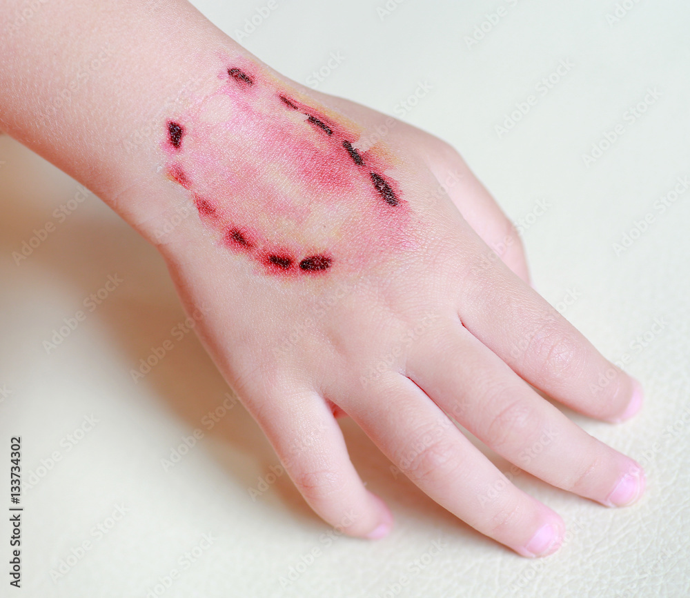 Sticker wound and blood from a bite human teeth on child hand, Dress up ...