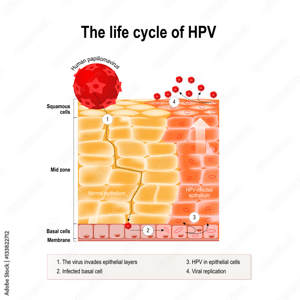Vetor De Life Cycle Of Hpv Do Stock Adobe Stock Vetor De Life Cycle Of Hpv Do Stock Adobe Stock