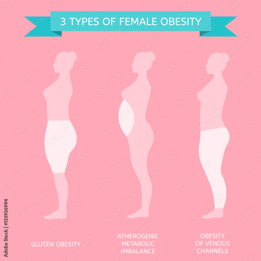 3 types of obesity. Female figure in profile Stock Vector | Adobe Stock