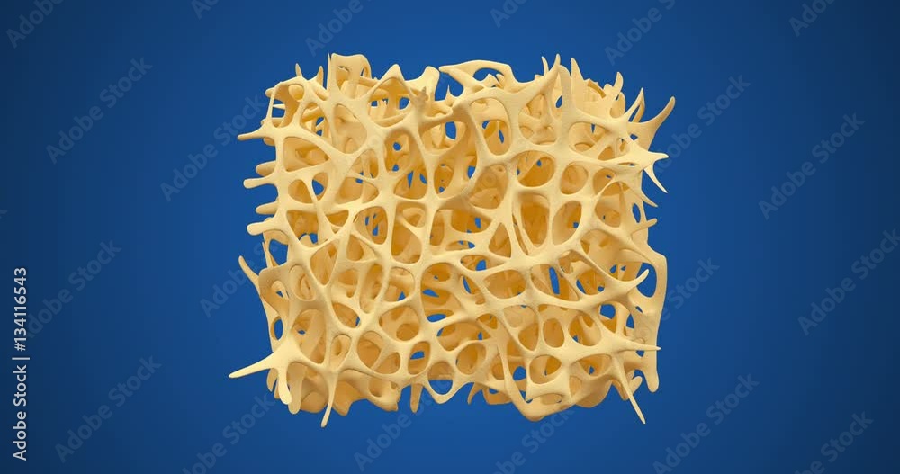 Developing of human bone osteoporosis spongy texture from normal to ...