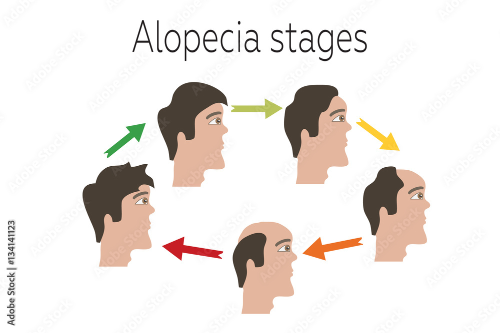 Alopecia stages set. Male baldness. Male hair loss pattern. Vector ...