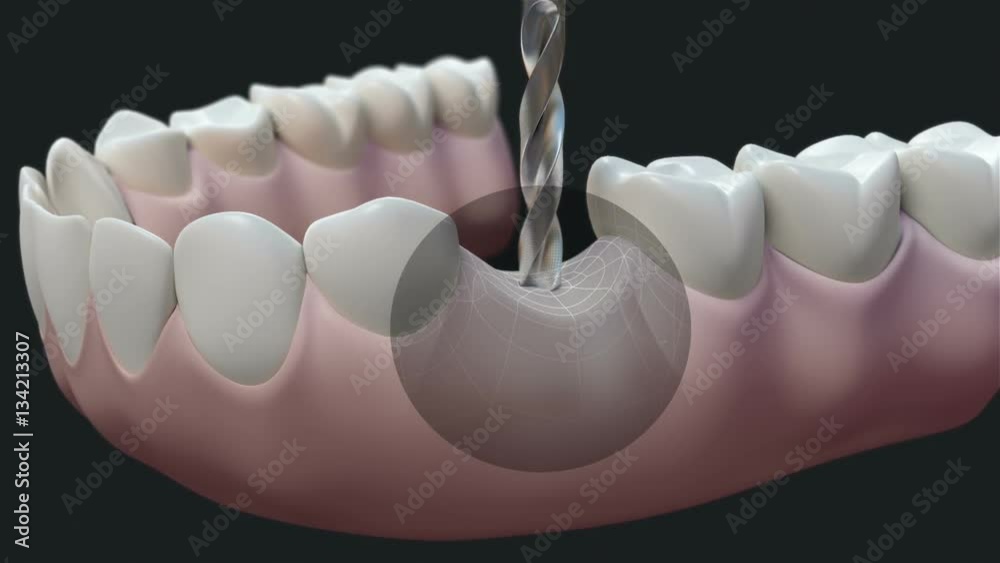 Dental Implant Dark. High quality animation 3D showing the installation ...