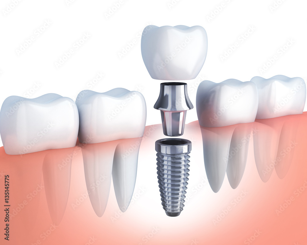 row tooth and Dental implant Stock Illustration | Adobe Stock
