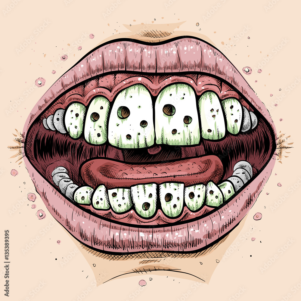 A cartoon close-up of a mouth with teeth filled with large cavities ...