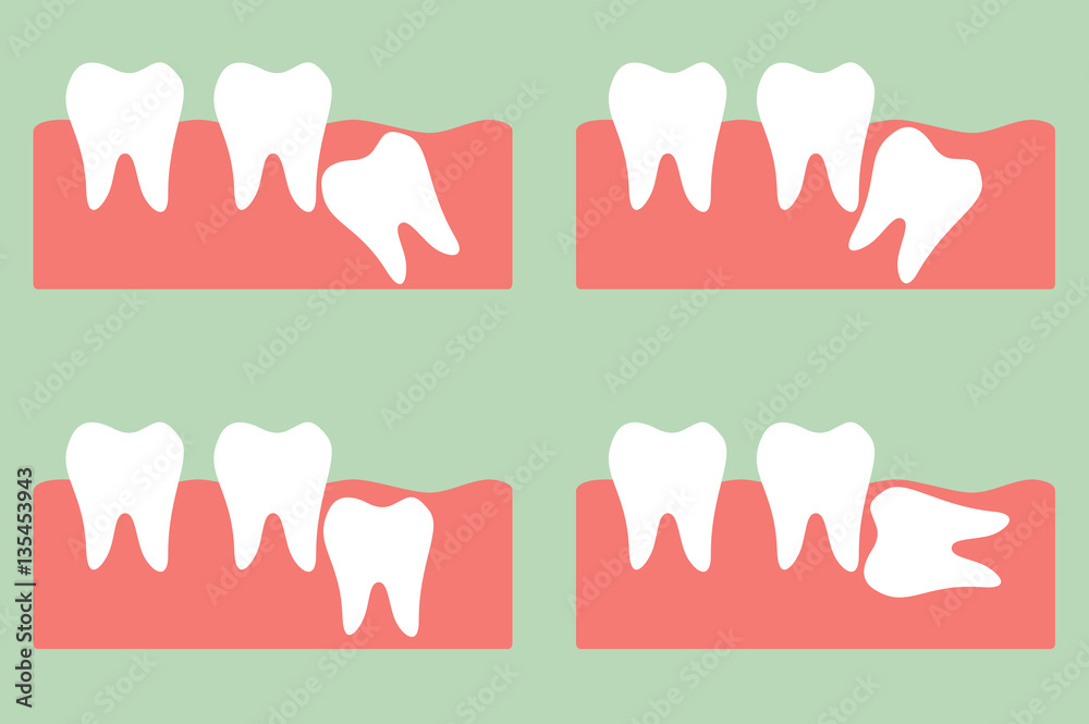 dental cartoon vector, set of wisdom tooth Stock Vector | Adobe Stock