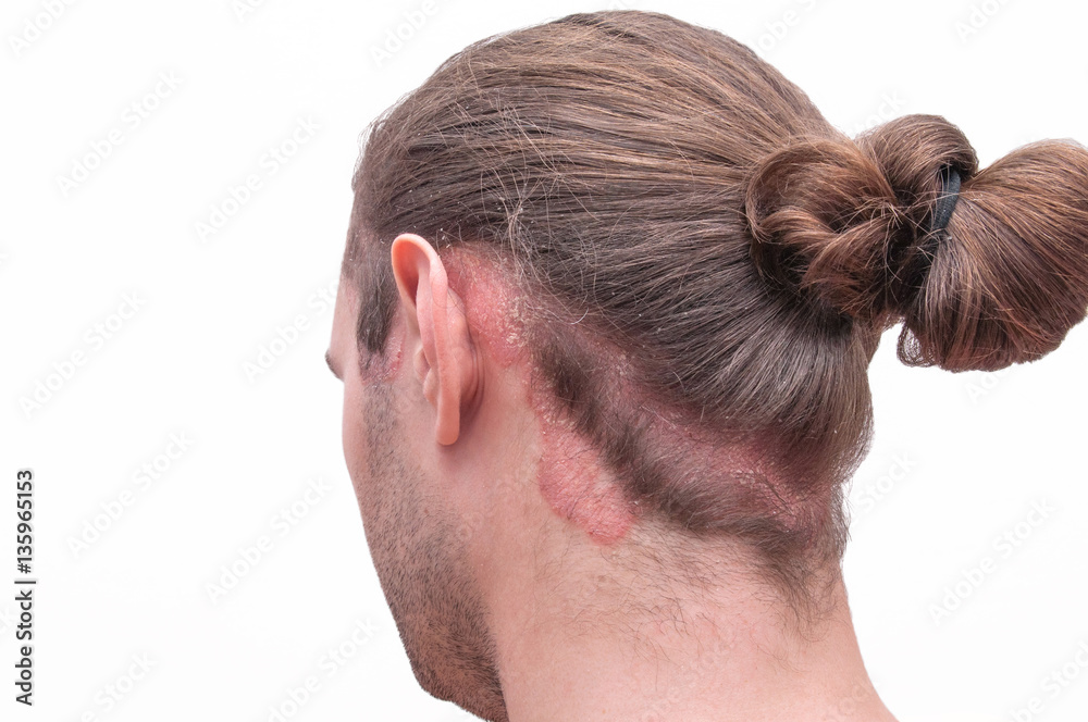 Red psoraitic spot on back of head and scalp hairline. Dermatological ...