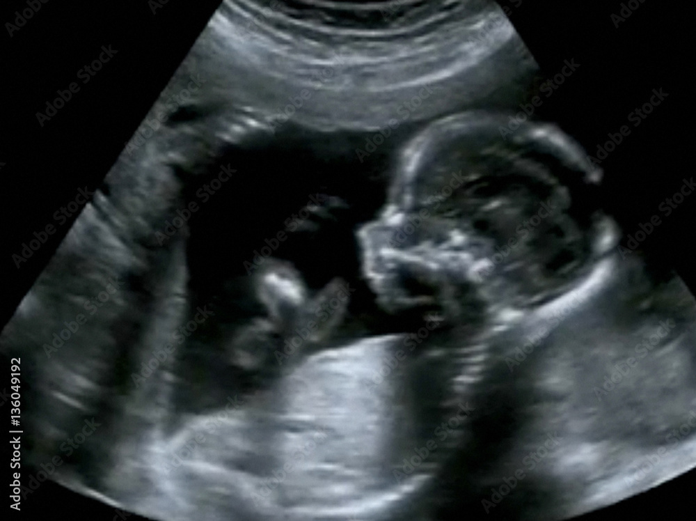 Obstetric Ultrasonography Ultrasound Echography of a first month Stock ...