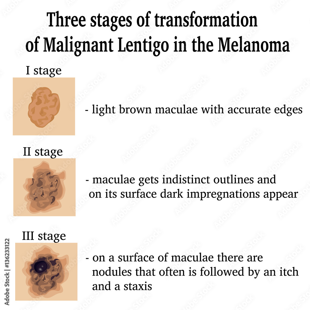 Three stages of transformation of Malignant Lentigo in the Melanoma ...