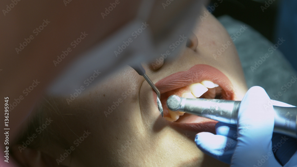 Medical dentist procedure of teeth polishing with cleaning from dental ...