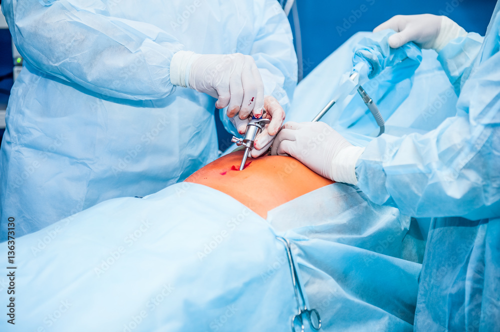 Complex laparoscopic operation on a peritoneal cavity is carried out in ...