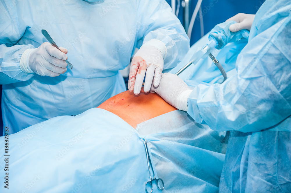 Complex laparoscopic operation on a peritoneal cavity is carried out in ...