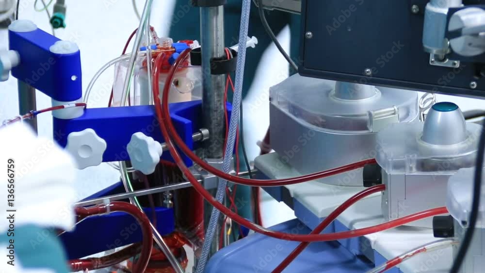 Heart lung machine for heart surgery Stock Video | Adobe Stock