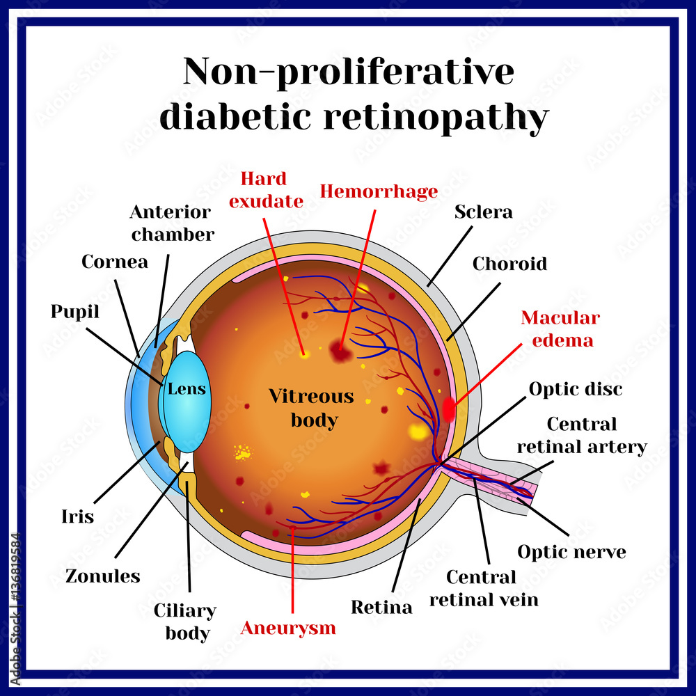 Non Proliferative Diabetic Retinopathy