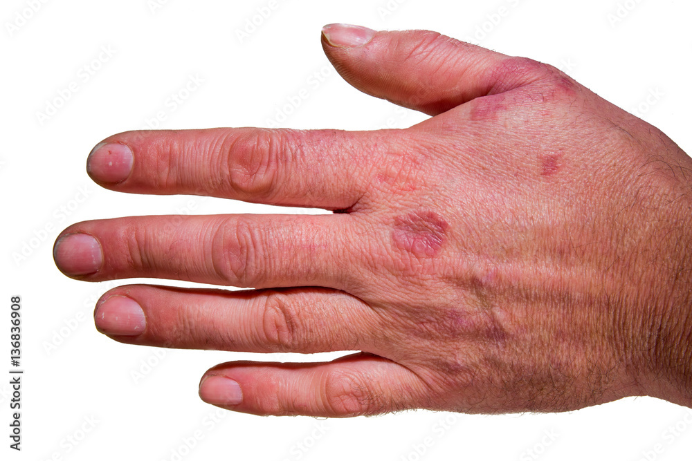 Hand mit Ausschlag / Ekzem ภาพถ่ายสต็อก | Adobe Stock