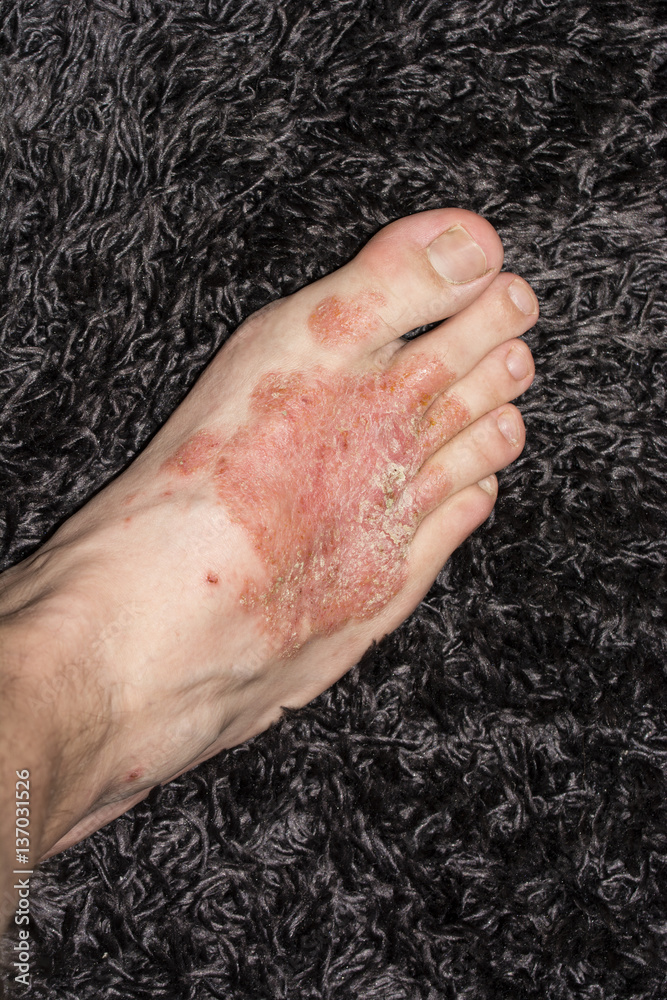 Disease of the skin on the foot - eczema. Stock Photo | Adobe Stock