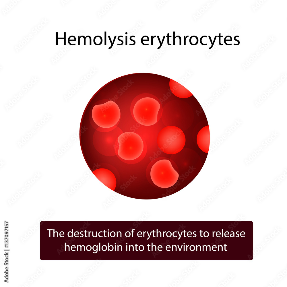 Erythrocytes. Hemolysis of red blood cells. Vector illustration on ...