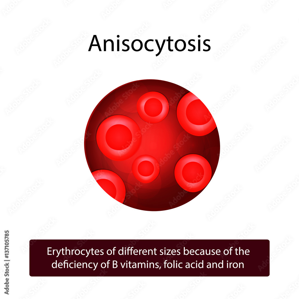 Anisocytosis. Red blood cells of different sizes because of the ...